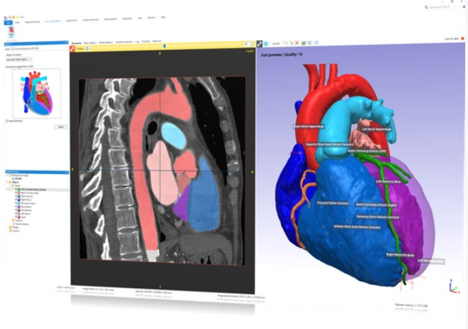 Aplicaciones de la segmentación médica con Simpleware