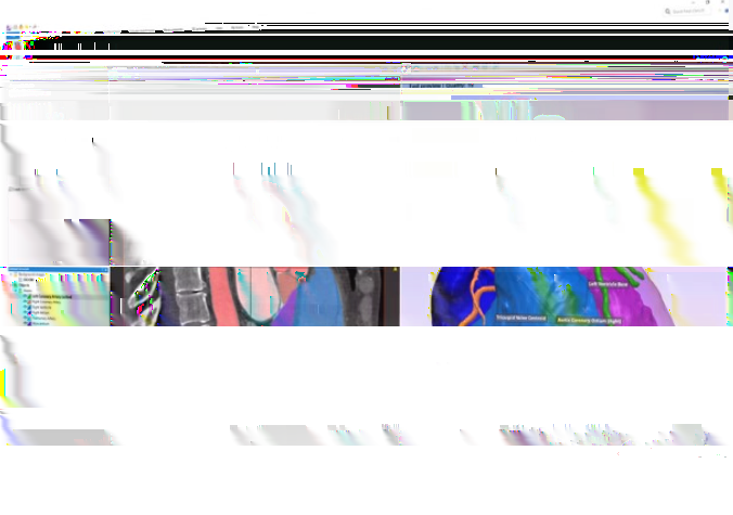 Aplicaciones de la segmentación médica con Simpleware