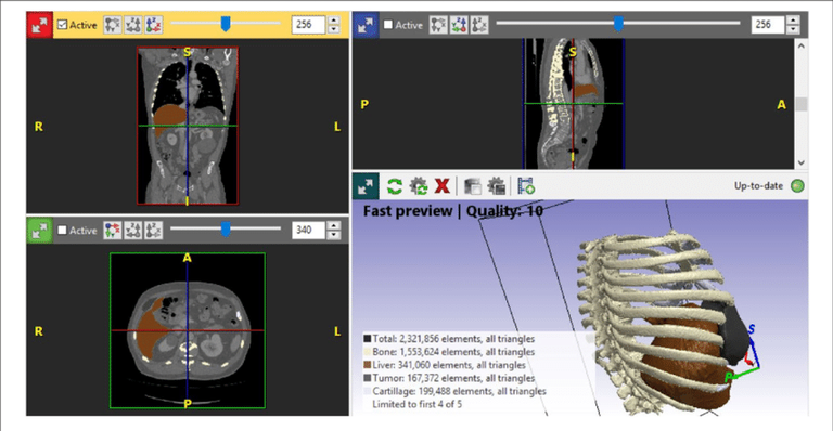 Aplicaciones de la segmentación médica con Simpleware